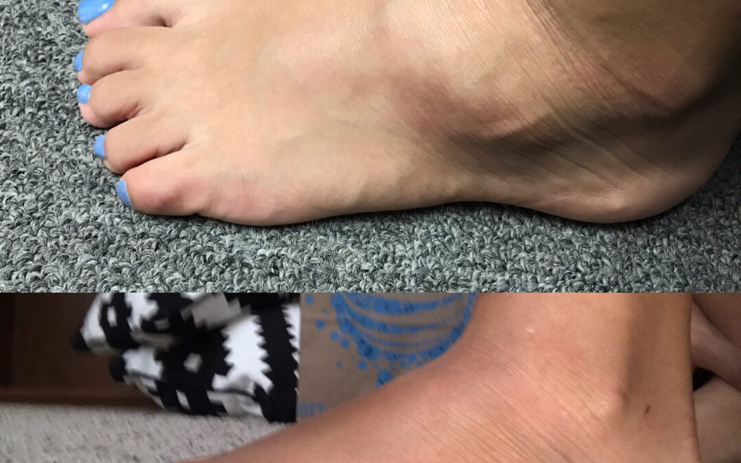 cryotherapy-for-post-injury-recovery | CryoFix Wellness